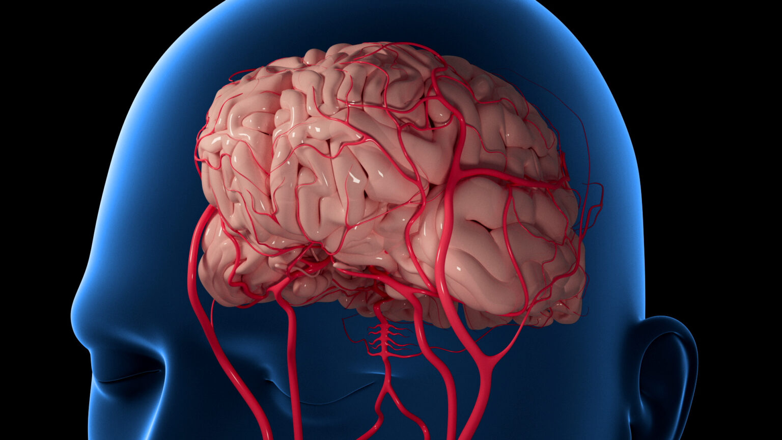 Aneurysm Coiling - Dr Ankit