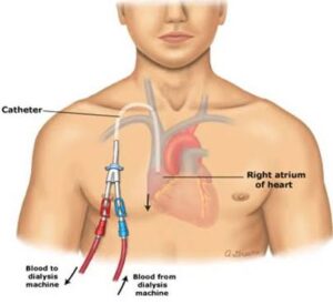 Permacath Placement - Dr Ankit